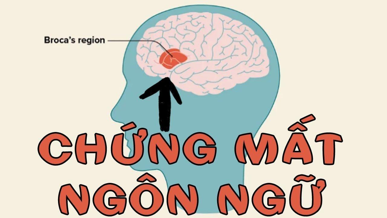 Chứng mất ngôn ngữ biểu hiện - chaobacsi.org